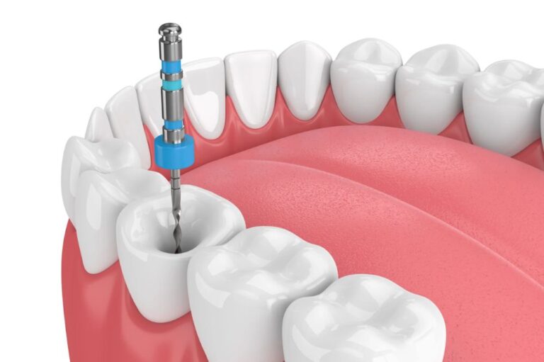 How Root Canal Therapy Helps Preserve Your Natural Smile